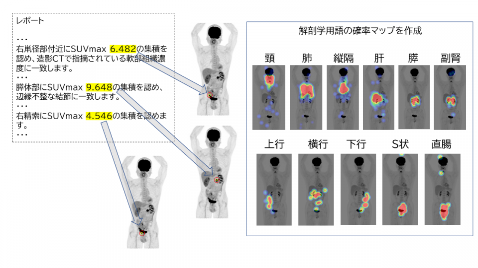 FDG-PET/CTのSUVmaxを病変の識別子として使用したAIシステムの開発 – 北海道大学病院 医療 AI 研究開発センター