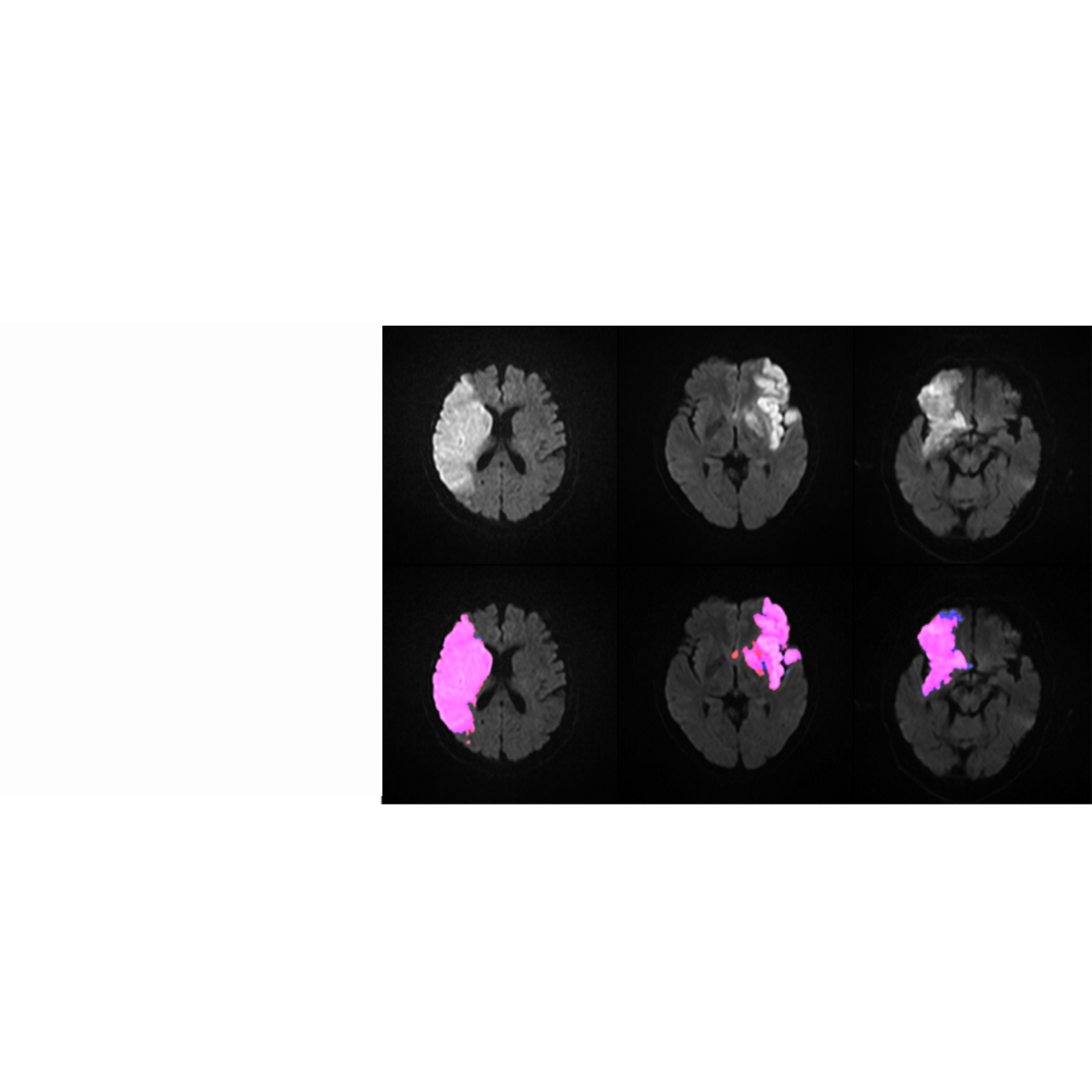 Development of AI for Supporting Image Diagnosis of Cerebral Infarction ...